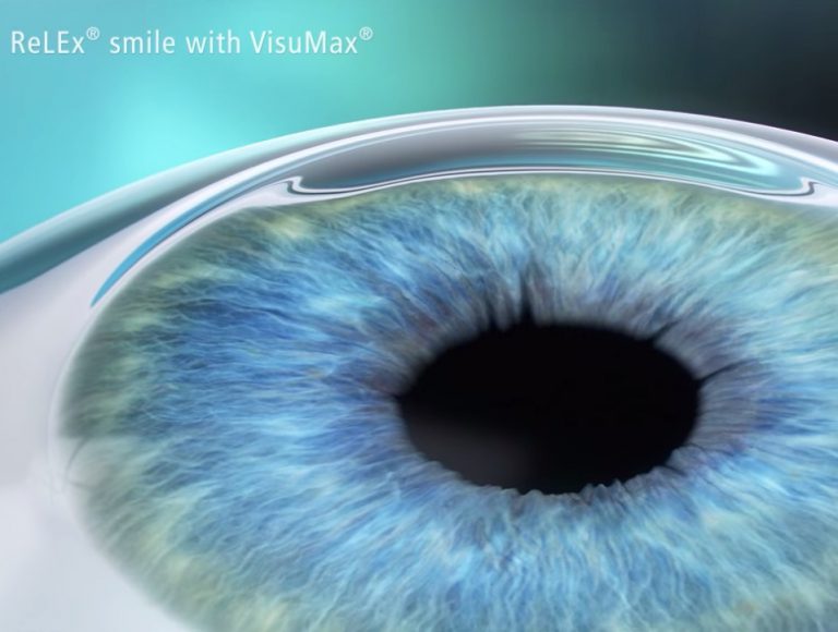ReLEx SMILE® – lo último en Cirugía Láser Ocular - Dr. Alfredo Ferrer