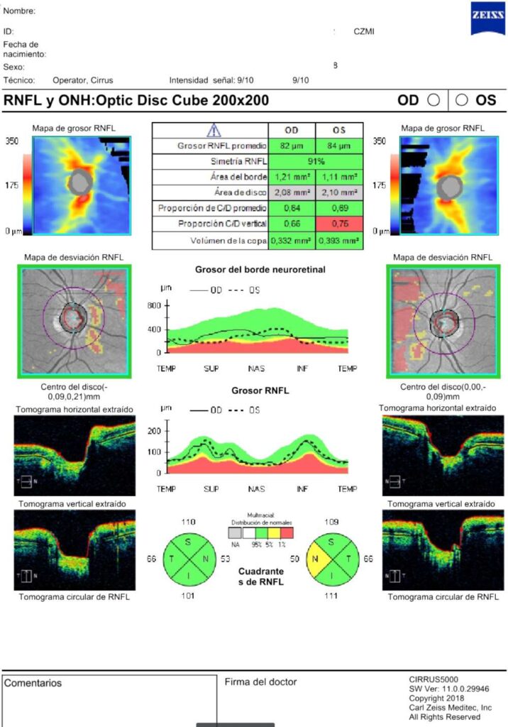 Tomografía de Coherencia Óptica (OCT) - Dr. Alfredo Ferrer